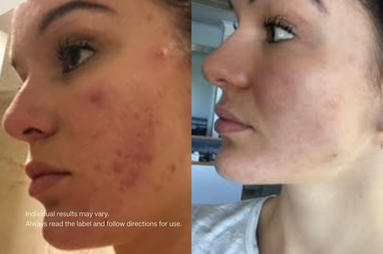 Clear skin from within - 100% natural, evidence-based ingredients – My ...